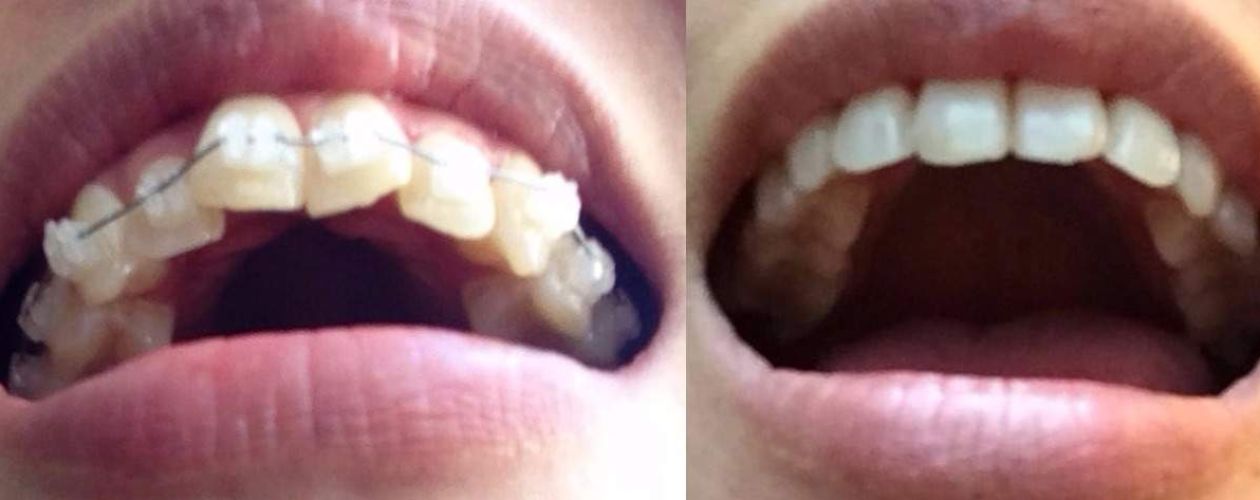 Adult Braces: My Experience, and How I Saved Over $2,000